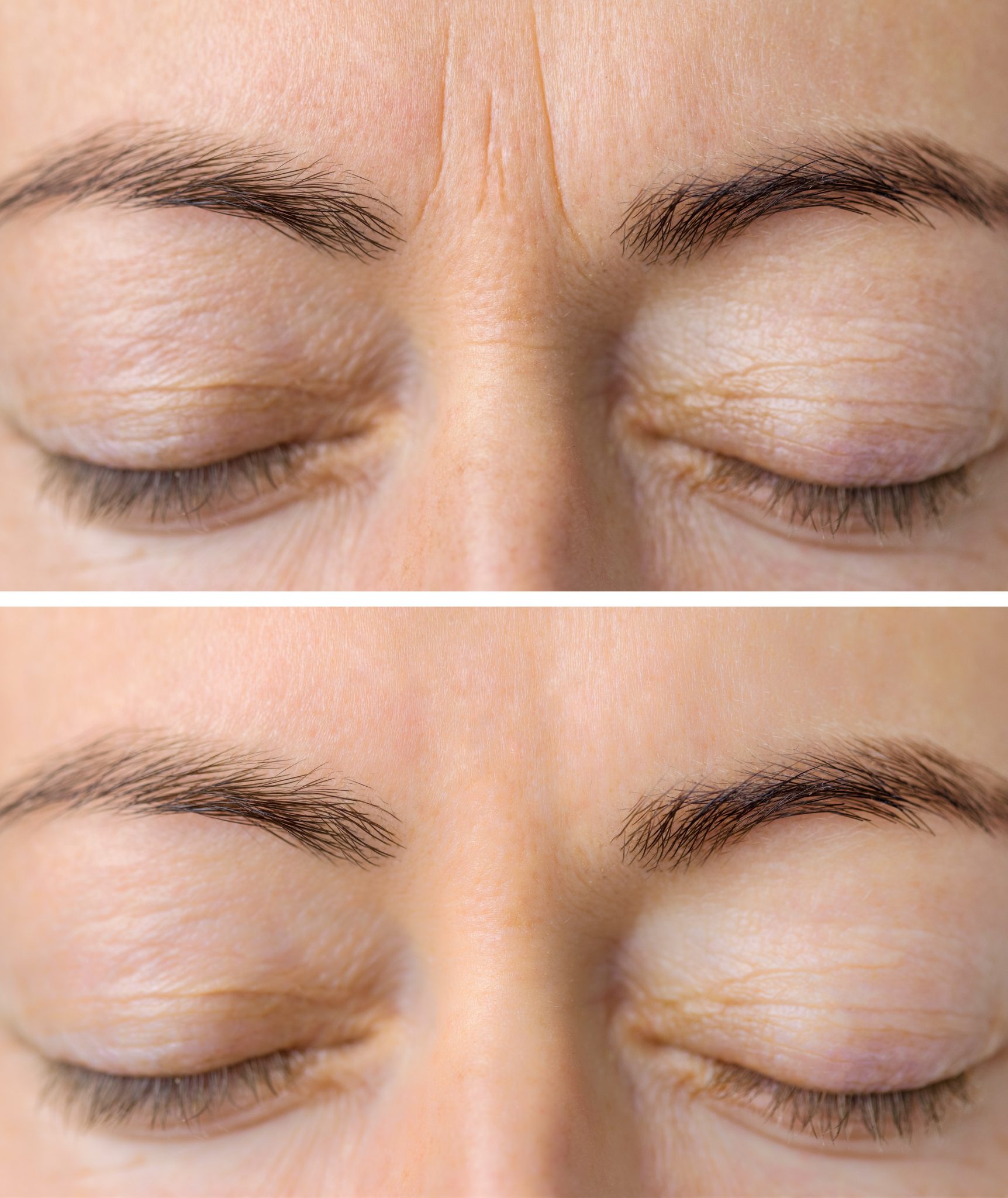 Faltenbehandlung – Aesthetik Praxis Angela Plass
